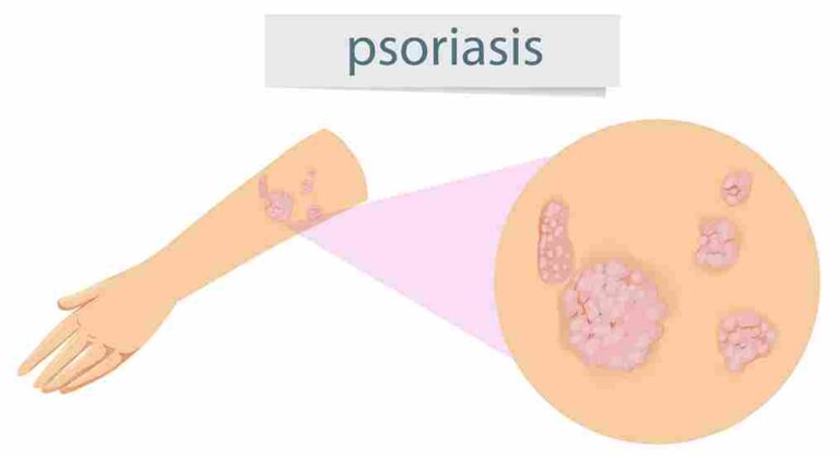 Different Psoriasis types and their treatments