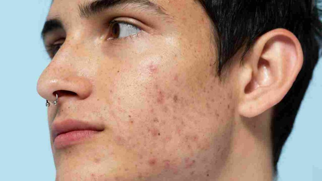 Types of Acne and Their Underlying Causes- Ayursparsh Clinic